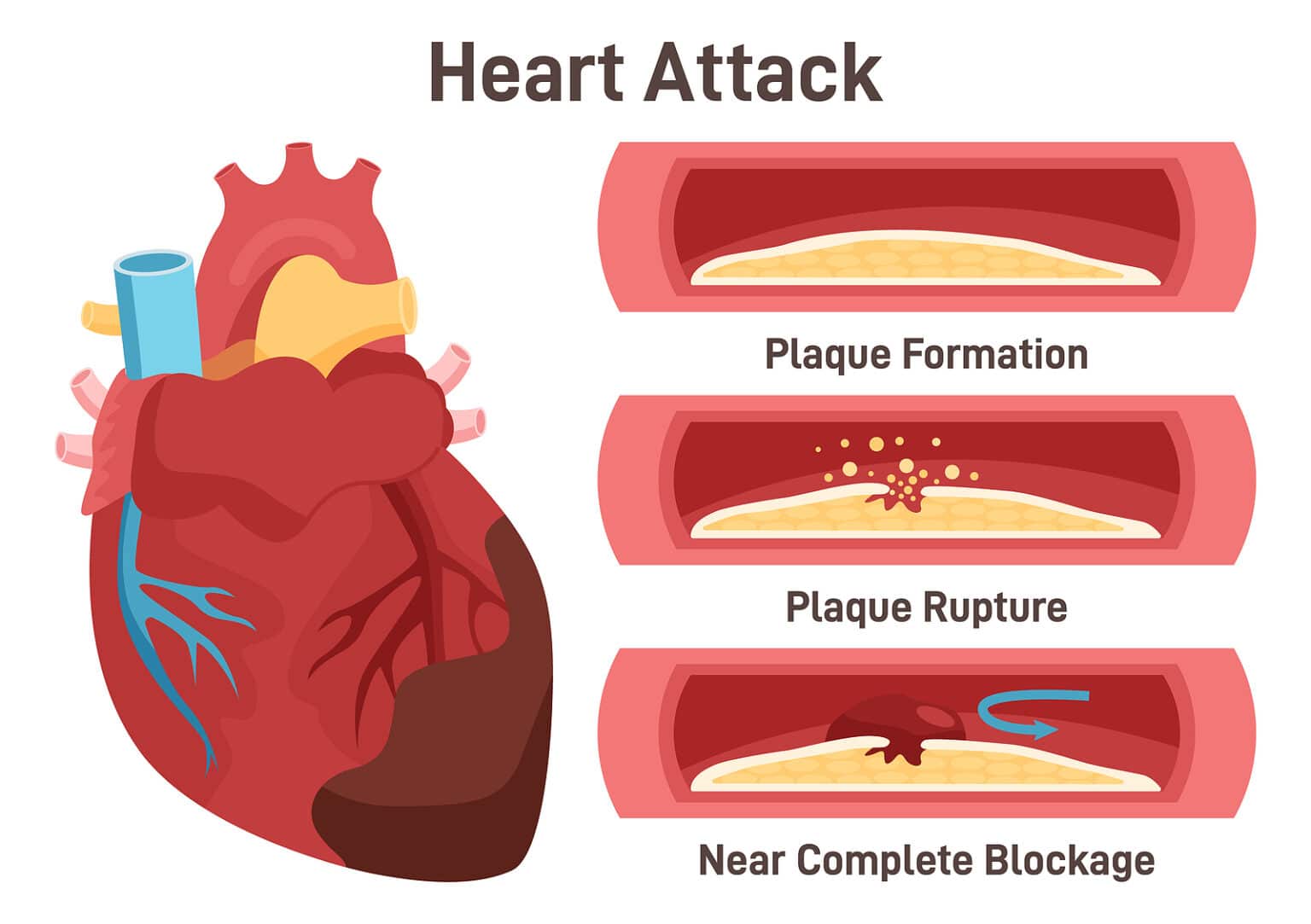 Health Effects of High Blood Pressure - Element Chiropractic